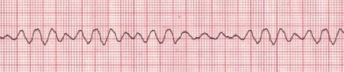 ACLS Ventricular Fibrillation and Pulseless Ventricular Tachycardia Guide