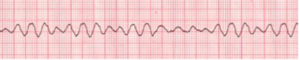 Ventricular Fibrillation and Pulseless Ventricular Tachycardia Guide