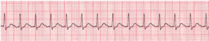 ACLS Stable and Unstable Tachycardia Guide