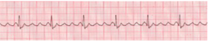 ACLS Stable and Unstable Tachycardia Guide