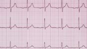 PQRST Wave Explained: ECG Interpretation Made Easy
