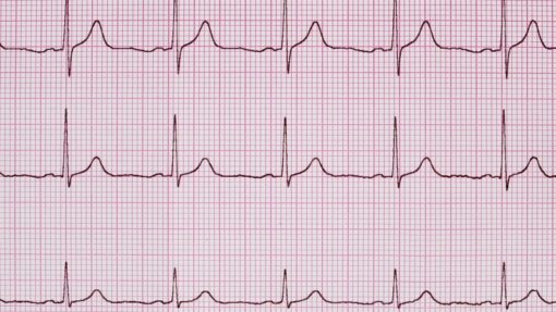 PQRST Wave Explained: ECG Interpretation Made Easy